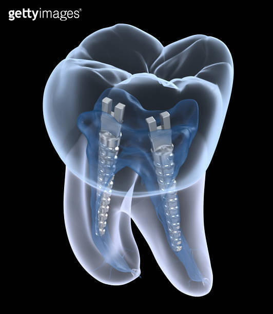Dental steel post inside molar teeth, Xray view. Dental endodontic ...
