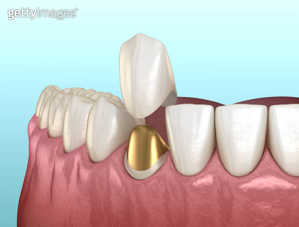 Golden stump pin tab on canaine tooth. Medically accurate dental 3D ...