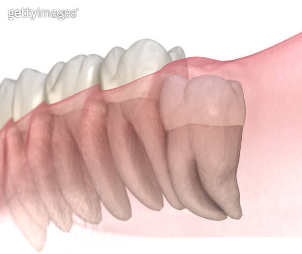 Vertical impaction of Wisdom tooth. Medically accurate tooth 3D ...