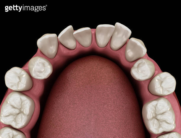 Abnormal teeth position, orthodontic concept. Medically accurate tooth ...