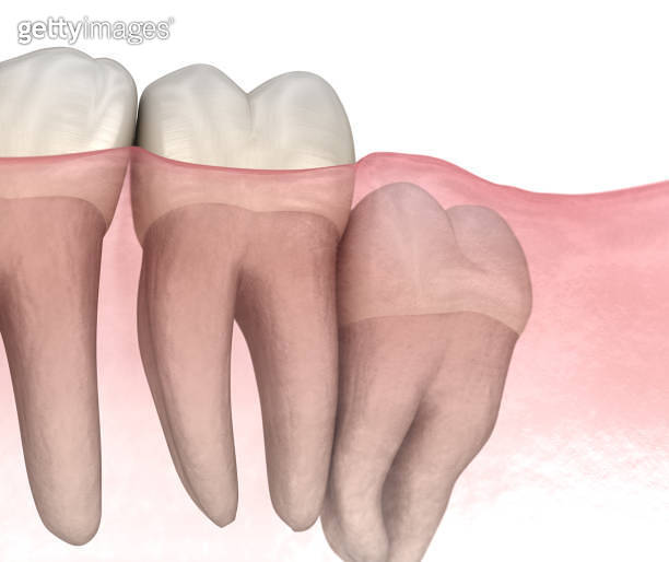 Vertical impaction of Wisdom tooth. Medically accurate tooth 3D ...