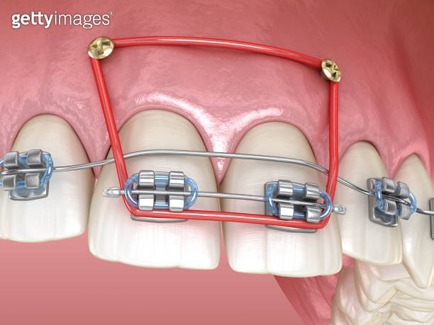Elastics and metal braces for correction overbite of frontal incisors ...