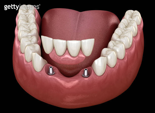Frontal teeth bridge supported by implants. Medically accurate 3D ...