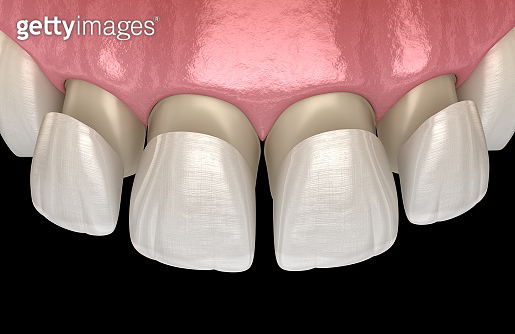 Veneer installation procedure over central incisor and lateral incisor ...