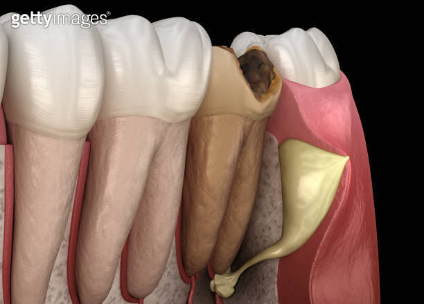 Periostitis tooth - Lump on Gum Above Tooth. Medically accurate dental ...