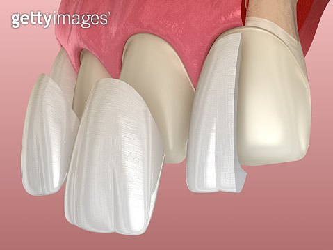 Veneer installation procedure over central incisor and lateral incisor ...