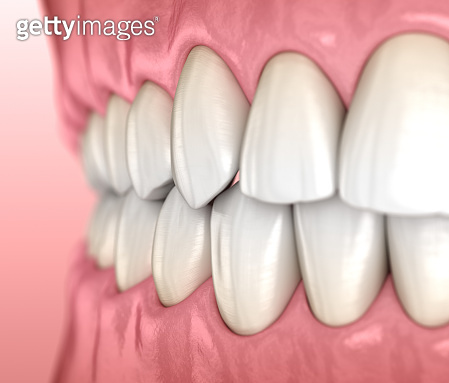 Healthy human teeth with normal occlusion, side view. Medically ...
