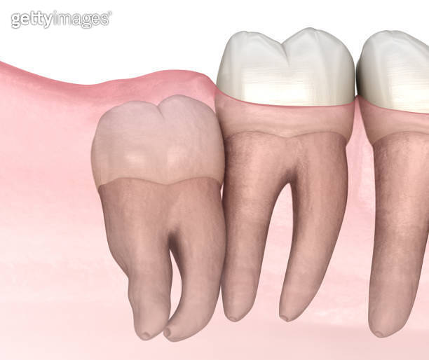 Vertical impaction of Wisdom tooth. Medically accurate tooth 3D ...