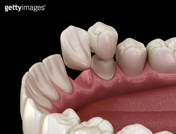 Cantilever bridge made from ceramic, frontal tooth recovery. Medically ...