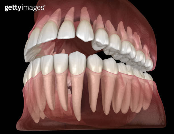 Morphology of mandibular and maxillary human gum and teeth. Medically ...