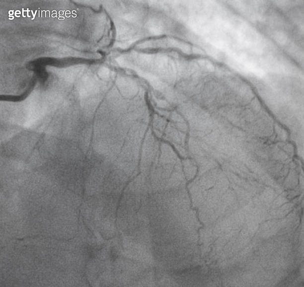 Coronary angiography , left coronary angiography 이미지 (1185661941) - 게티이미지뱅크
