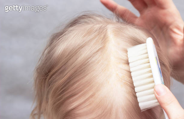 Mother combing seborrheic crust on baby s head, close-up, Seborrhoeic ...