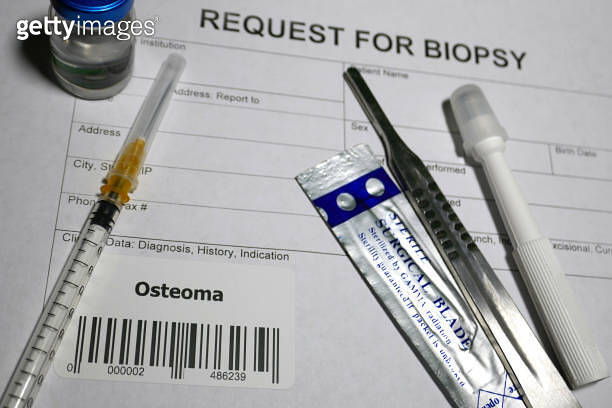 Osteoma Biopsy 이미지 1128842794 게티이미지뱅크