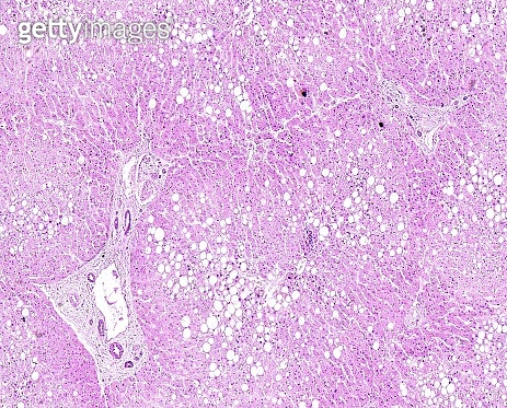 Histology of human tissue, show liver fatty degeneration as seen under ...
