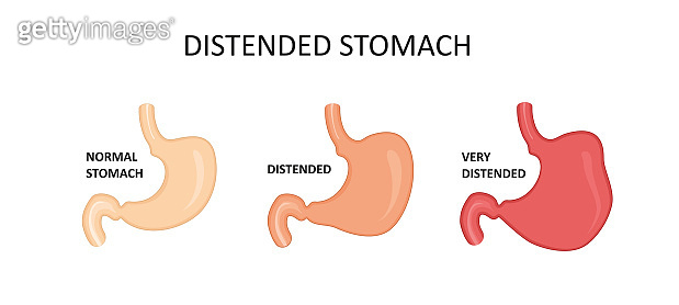 Types of stomachs for obesity 이미지 (1137738559) - 게티이미지뱅크