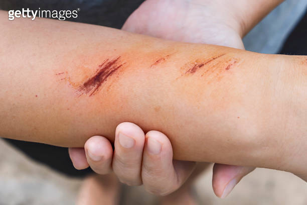 The wound form scabs on hand and arm. The wound happen during woman ...