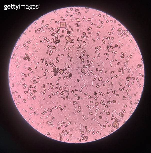Urine analysis finding with microscope show tripple phosphate crystal ...