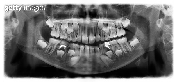 Panoramic radiograph is a panoramic scanning dental X-ray of the upper ...