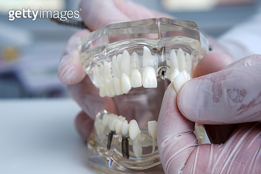 the orthodontist holds a model of teeth with implants in his hand and ...