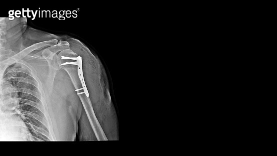 Film x ray shoulder radiograph show shoulder bone broken (neck of ...