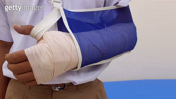 Patient 's broken bone treated by cast. Traumatic accidental injury ...