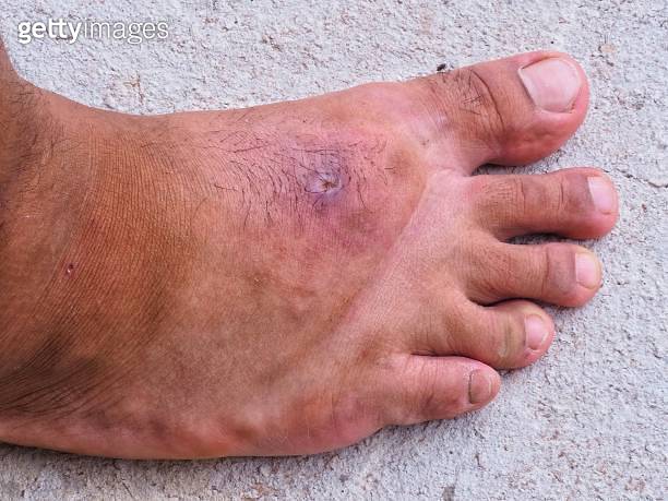 foot burns and wound caused by sunlight. dangers of sun burned skin ...