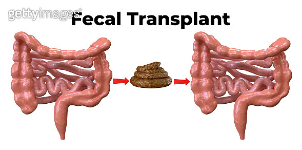 Fecal microbiota transplantation is a procedure in which a donor's ...