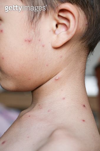 Chicken pox rash on young boy body.Chickenpox is an infection caused by ...