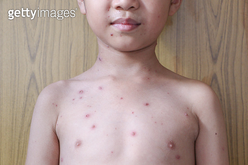 Chicken pox rash on young boy body.Chickenpox is an infection caused by ...