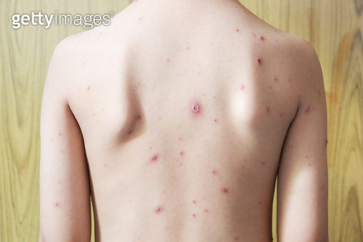 Chicken pox rash on young boy body.Chickenpox is an infection caused by ...