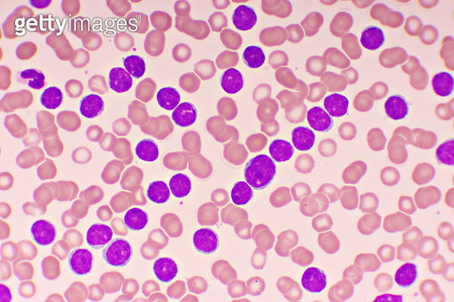 Blood picture of chronic lymphocytic leukemia or CLL 이미지 (1190863700 ...