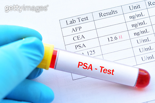 Abnormal high PSA test result 이미지 (1131168161) - 게티이미지뱅크
