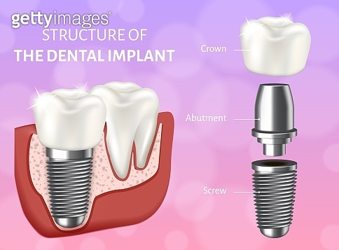 Vector illustration depicting the structure of the dental implant ...