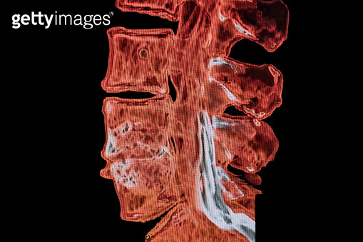 MRI Spine image lateral view 이미지 (1150807538) - 게티이미지뱅크