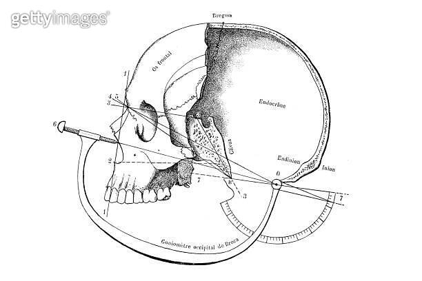 Facial angle, sphenoidal angle, occipital angle and atrioventricular ...