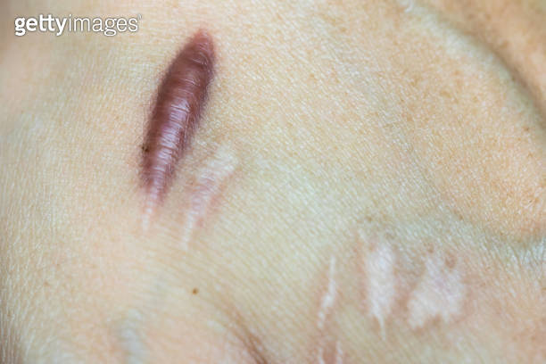 Keloid scar (Hypertrophic Scar) on man hand skin after accident ...