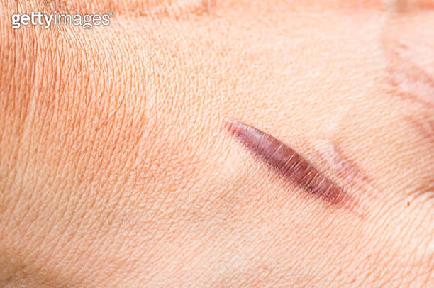 Keloid scar (Hypertrophic Scar) on man hand skin after accident ...