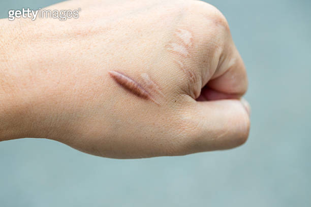 Keloid scar (Hypertrophic Scar) on man hand skin after accident ...