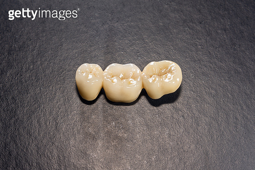 Ceramic tooth crowns and metal pins close-up macro. Orthopedic ...