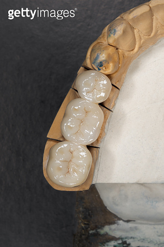 Ceramic tooth crowns and metal pins close-up macro. Orthopedic ...