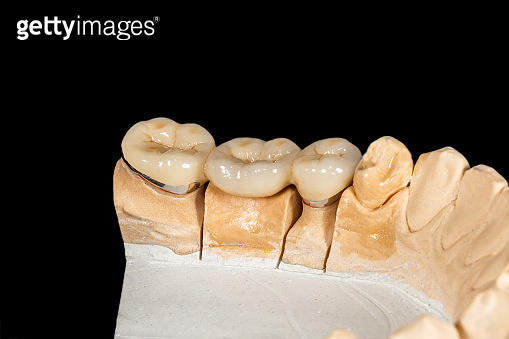 Ceramic tooth crowns and metal pins close-up macro. Orthopedic ...