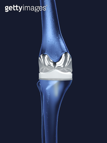 Artificial knee prosthesis or knee joint in blue shades - 3D ...