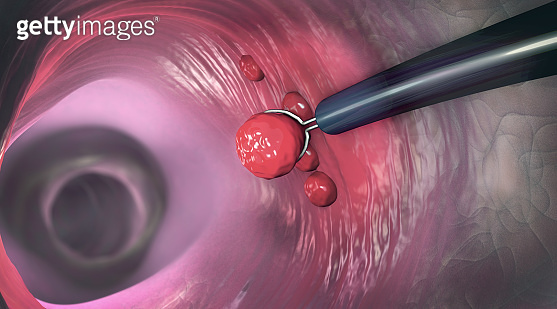 Removal of a colonic polyp with a electrical wire loop during a colonoscopy - 3d illustration ...