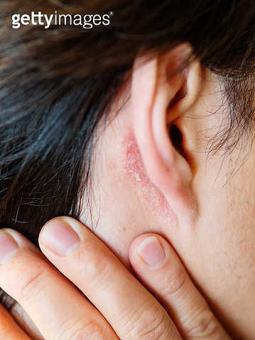 Irritation on the skin behind the ear. Man with flaky skin. Allergy or ...