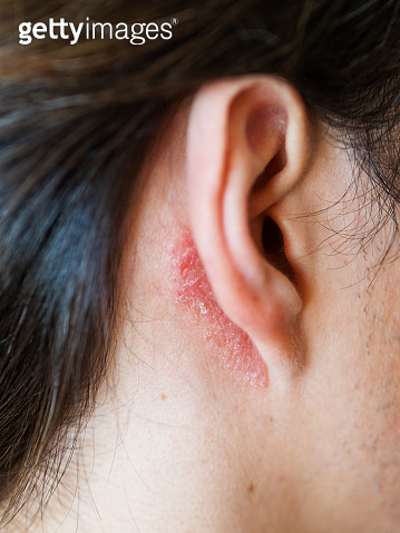 Irritation on the skin behind the ear. Man with flaky skin. Allergy or ...