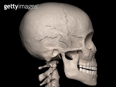 Linear Cranial Vault fracture of the Temporal bone (cranial fracture ...