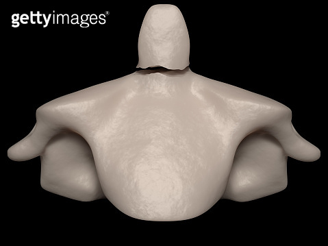 Type II fracture of the Odontoid process (Dens) of the Axis (C2 ...