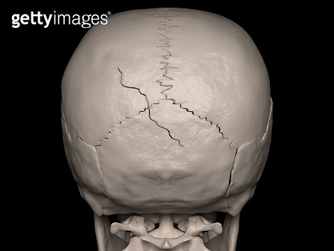 Contiguous Cranial Vault fracture of the Parietal-and Occipital bone ...