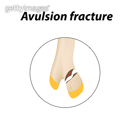 Avulsion fracture Bone. Infographics. Vector illustration on a lined ...