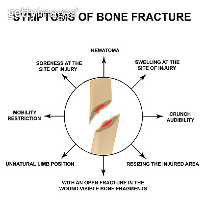 Symptoms of bone fracture. Bone fracture with displacement ...